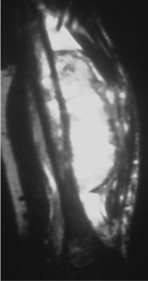 Ewing's Sarcoma - Pathology - Orthobullets