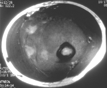 Ewing's Sarcoma - Pathology - Orthobullets