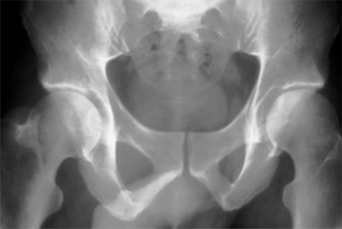 Ewing's Sarcoma - Pathology - Orthobullets