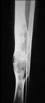 Adamantinoma - Pathology - Orthobullets