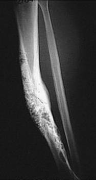 Adamantinoma - Pathology - Orthobullets