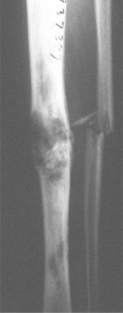 Adamantinoma - Pathology - Orthobullets