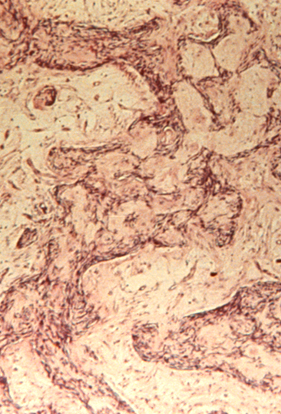 Adamantinoma - Pathology - Orthobullets