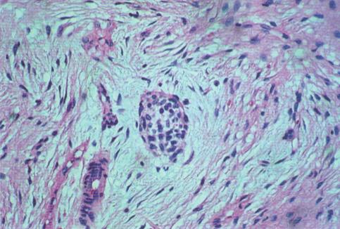 Adamantinoma - Pathology - Orthobullets