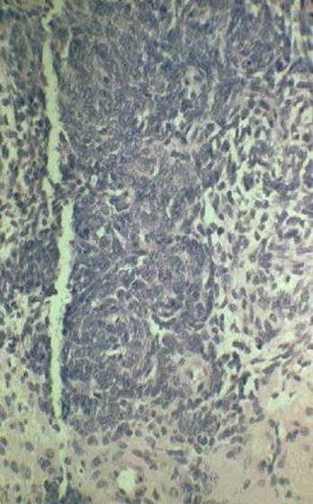 Synovial Sarcoma - Pathology - Orthobullets