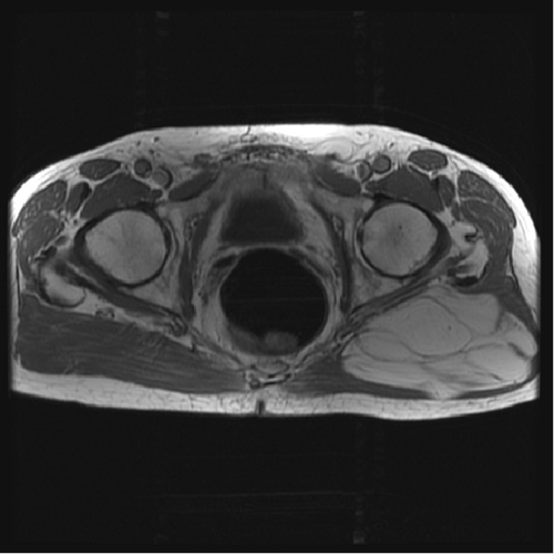 Lipomas - Pathology - Orthobullets