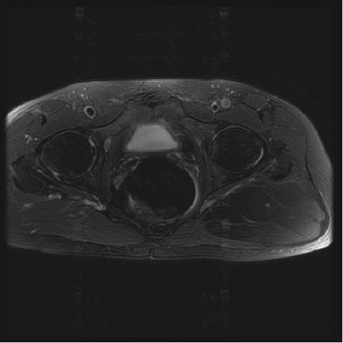 Lipomas - Pathology - Orthobullets