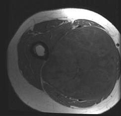 Liposarcoma - Pathology - Orthobullets