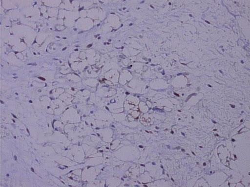 Liposarcoma - Pathology - Orthobullets