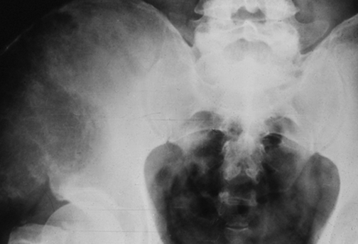 Angiosarcoma - Pathology - Orthobullets