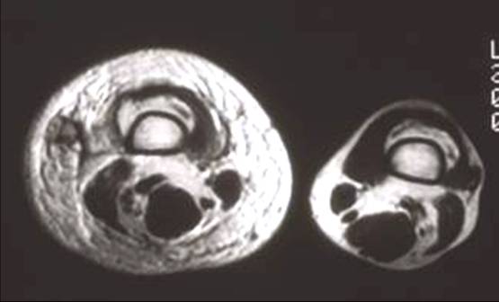 Angiosarcoma - Pathology - Orthobullets