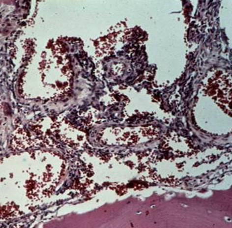 Angiosarcoma - Pathology - Orthobullets
