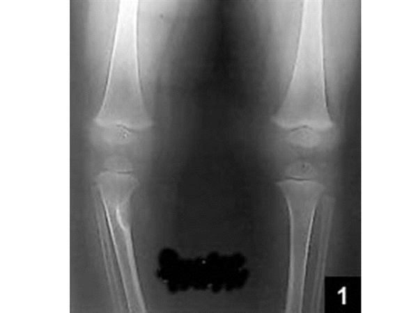 Focal Fibrocartilaginous Dysplasia - Pathology - Orthobullets