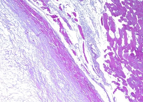 Intramuscular Myxomas - Pathology - Orthobullets
