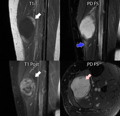 Intramuscular Myxomas - Pathology - Orthobullets