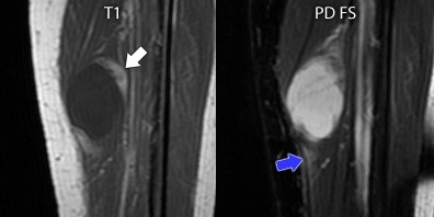Intramuscular Myxomas - Pathology - Orthobullets
