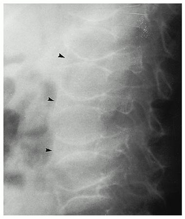 Rickets - Basic Science - Orthobullets