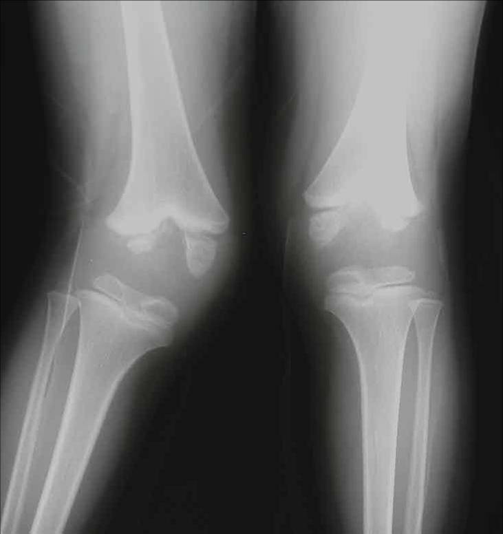 Hemophilic Arthropathy - Basic Science - Orthobullets