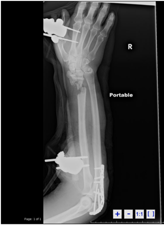 Orthopaedic Implants - Basic Science - Orthobullets